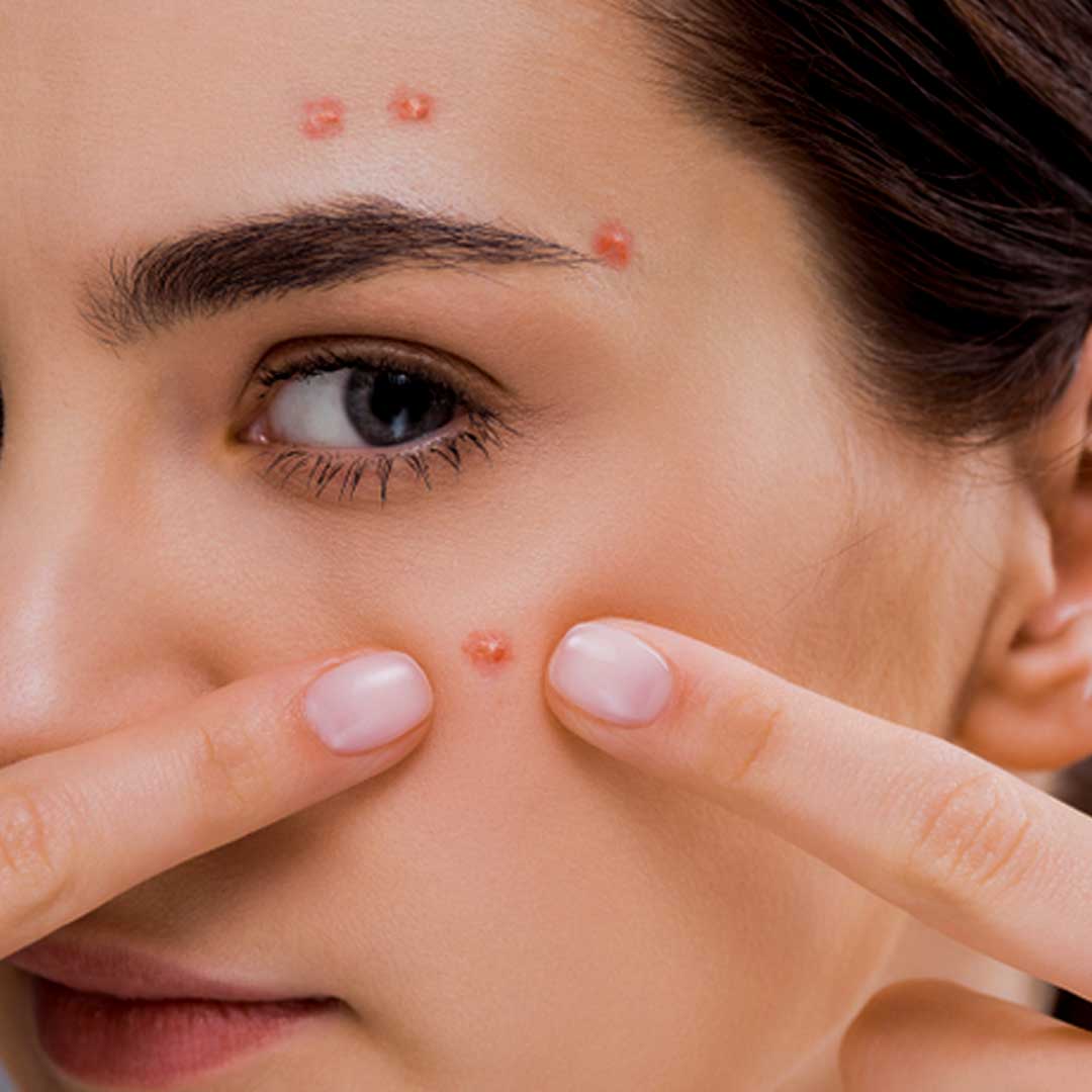 Acne – Rivela Dermascience